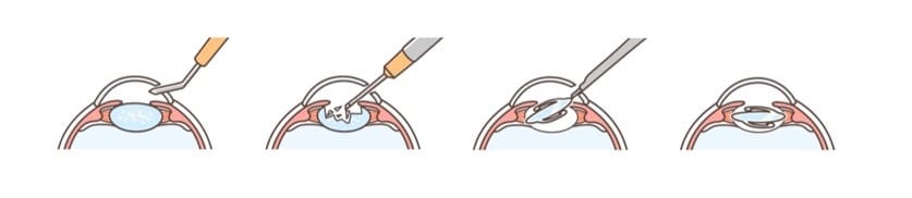 Cataract Surgery Tuscaloosa AL - Cataract Treatment AL